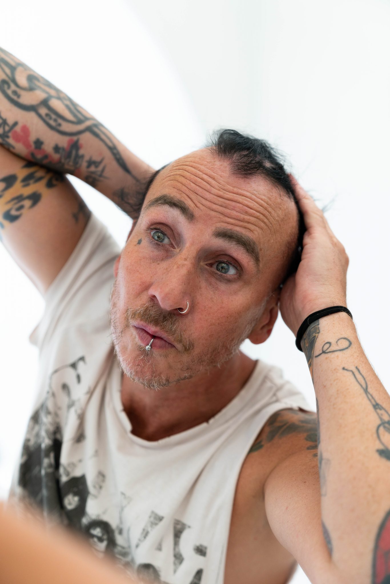 Alopecia Areata - the disease that causes patchy hair loss – Nordic Hair