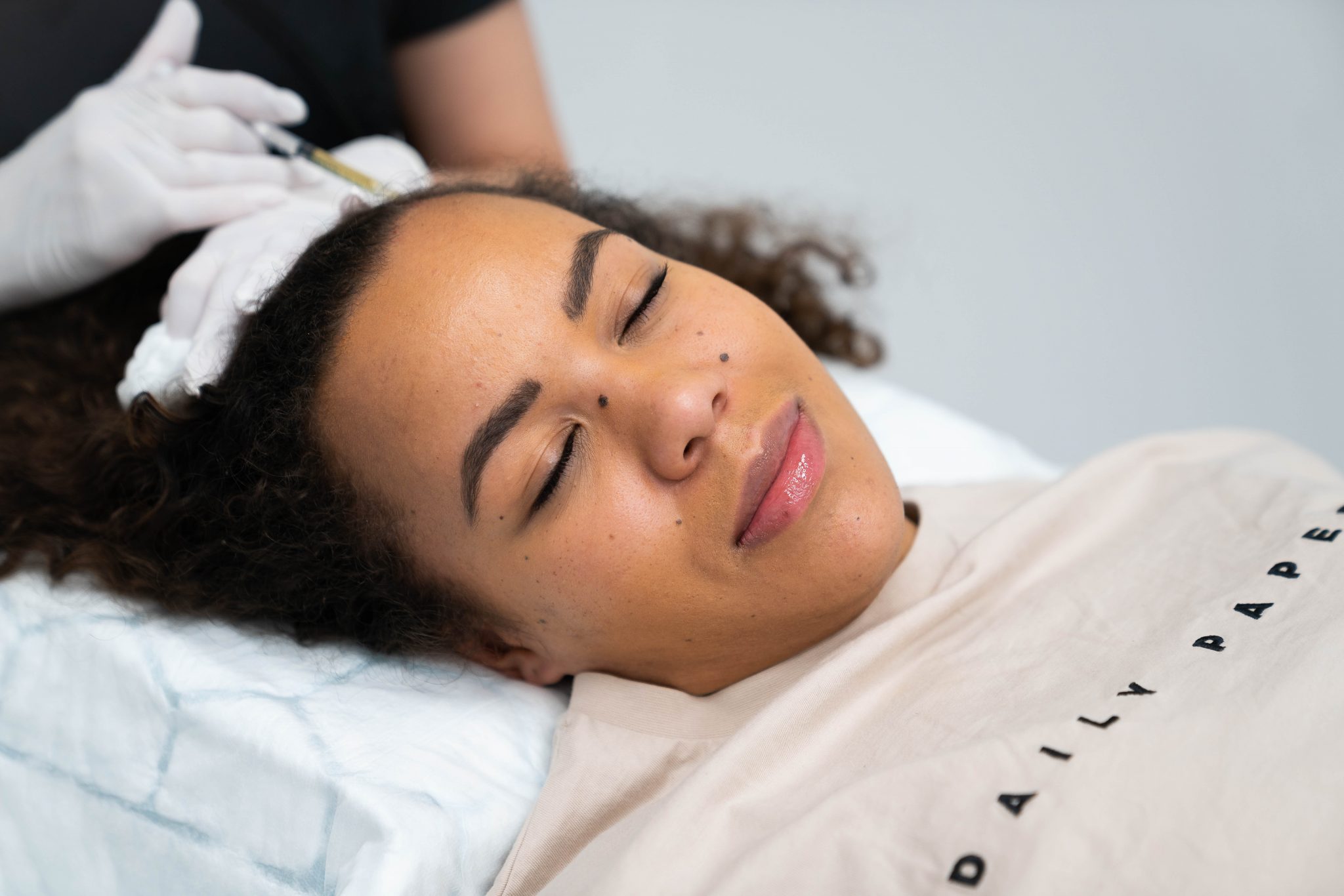 Androgen alopeci - Male pattern baldness – Nordic Hair