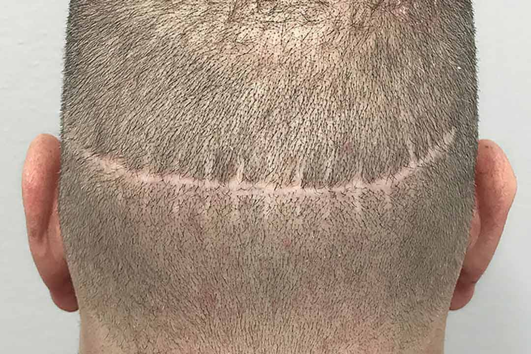 How the FUE technique works – Nordic Hair