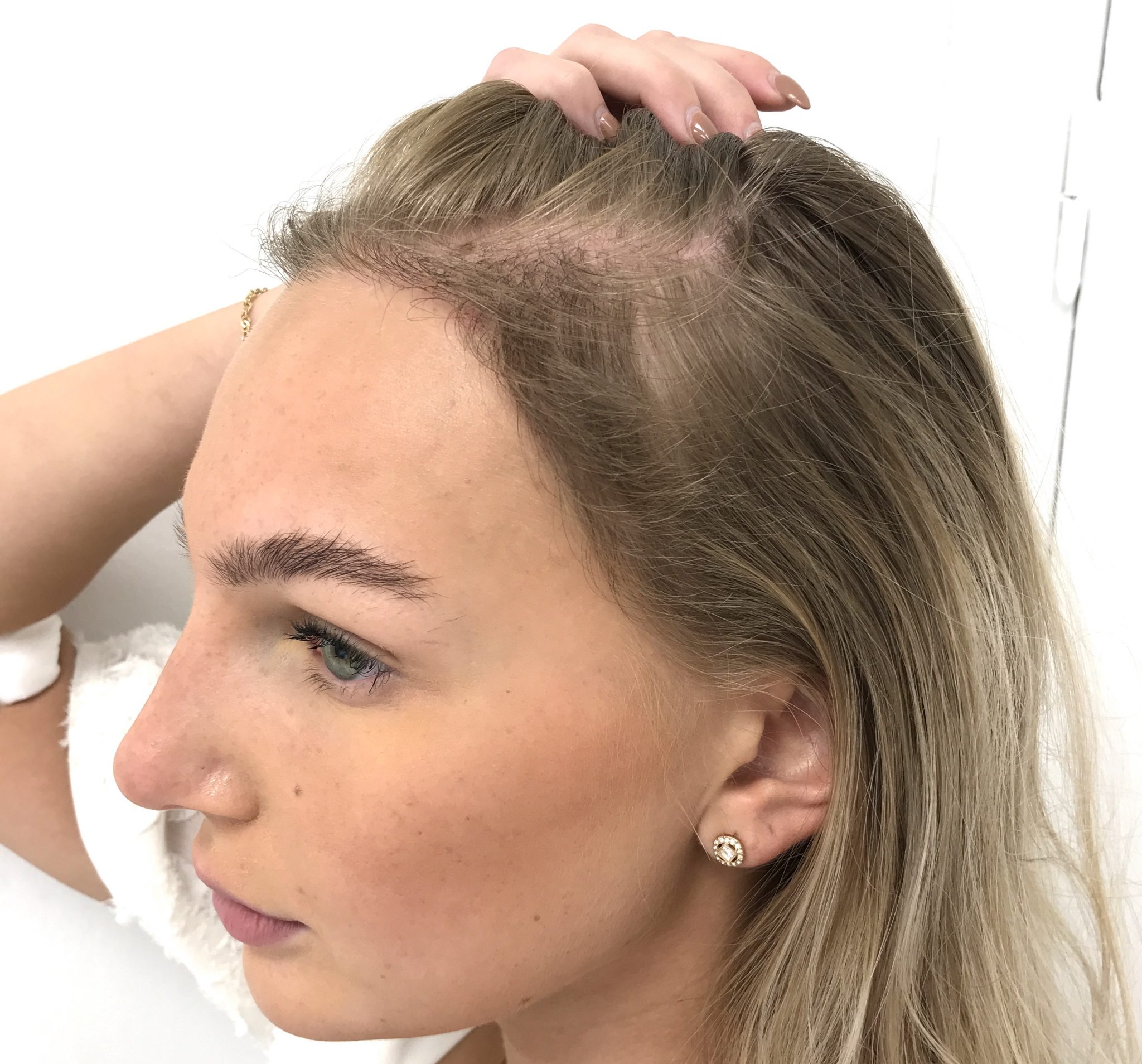 How does the hair grow after a hair transplant? – Nordic Hair