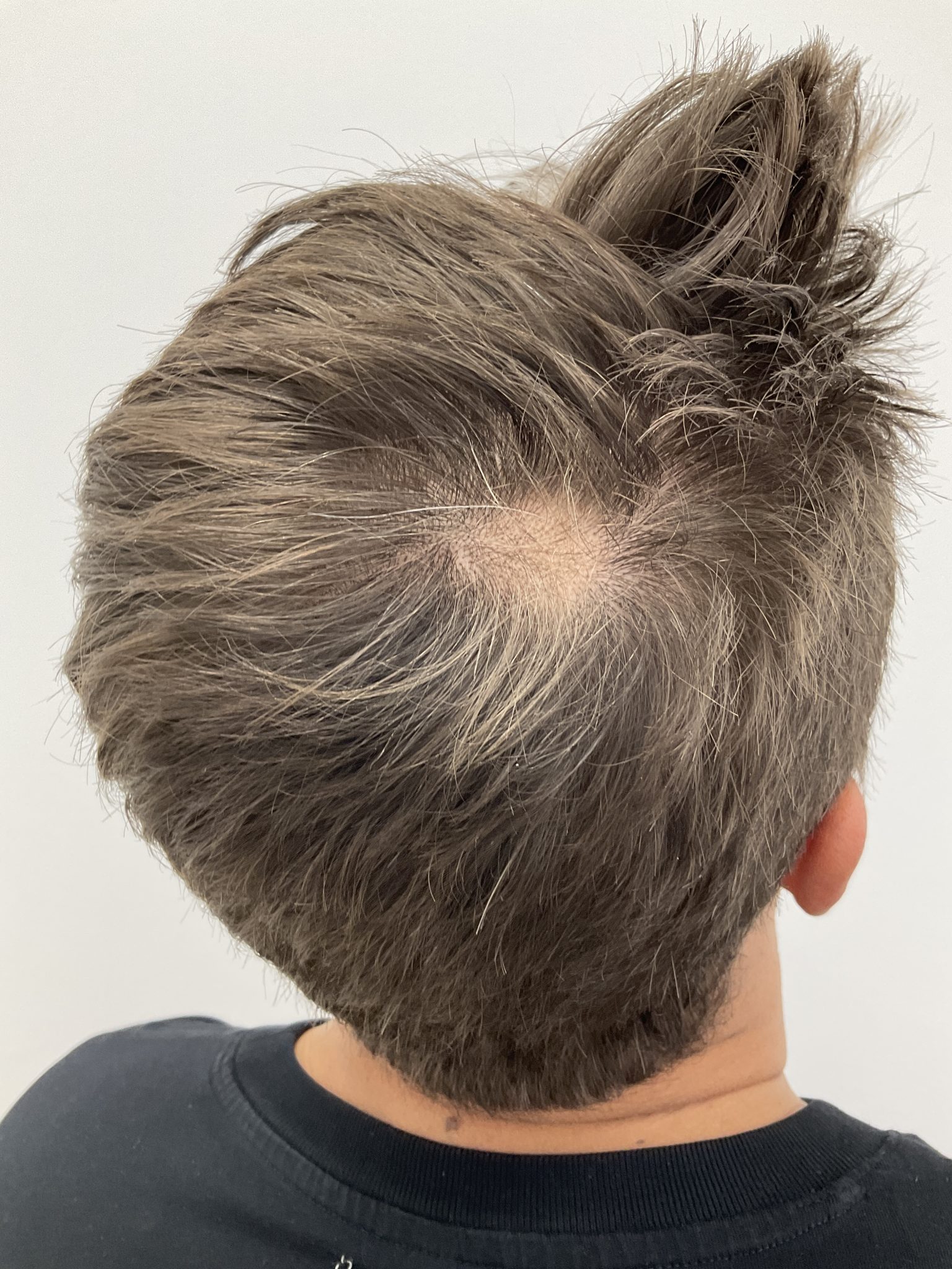 Hair loss | Are you losing hair? | Stop your hair loss at Nordic Hair