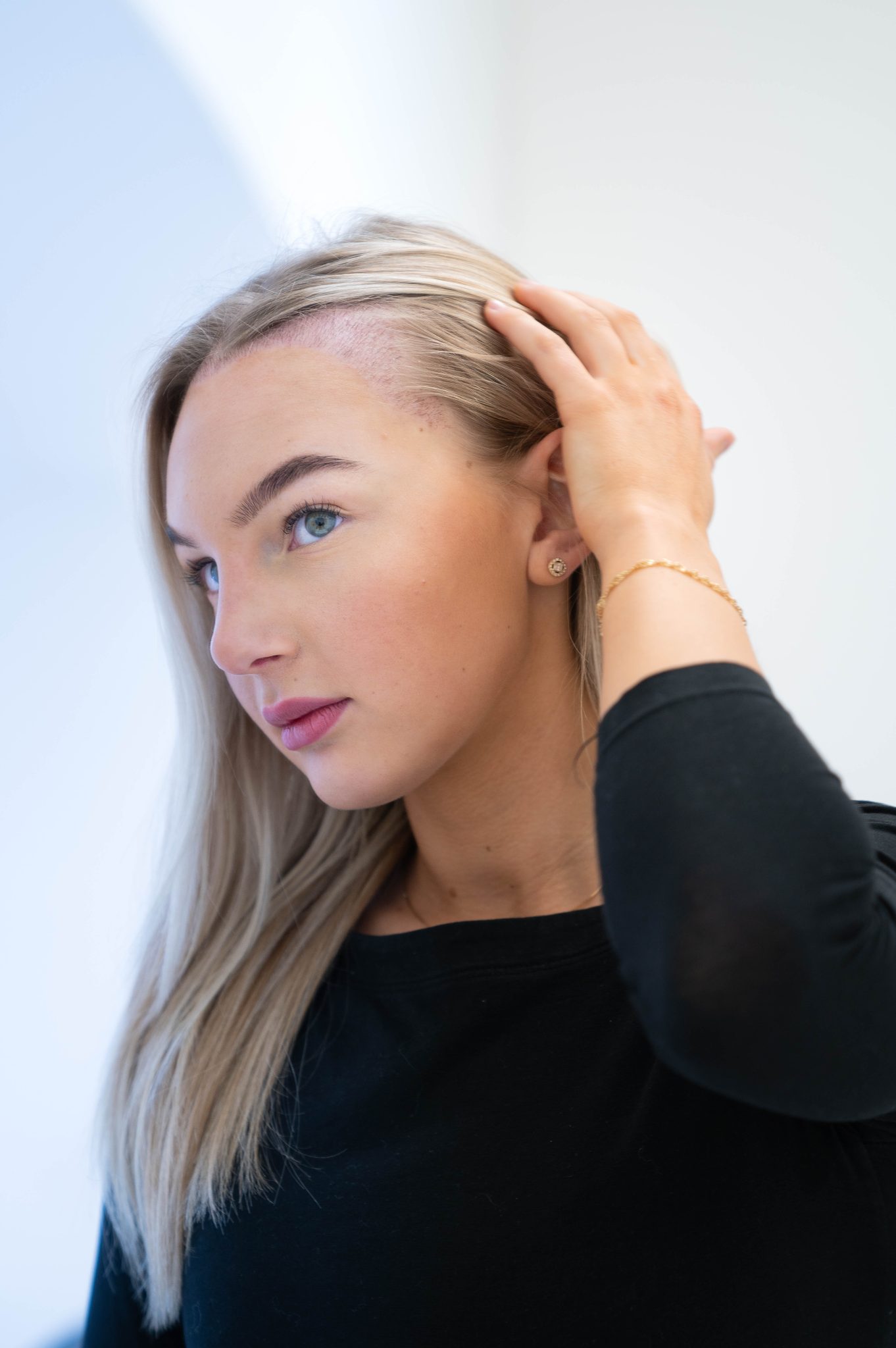 Alopecia totalis - hair loss on the entire head – Nordic Hair