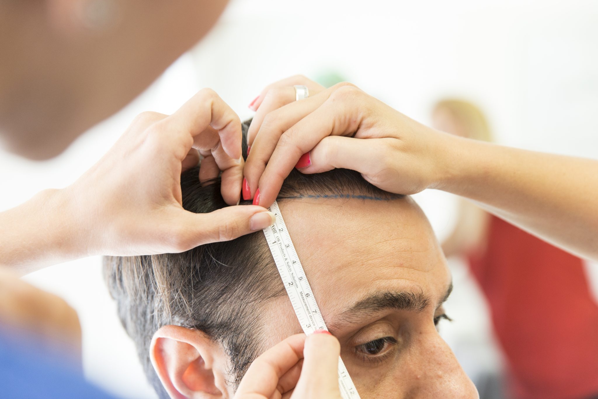 High temples, what is the cause? – Nordic Hair